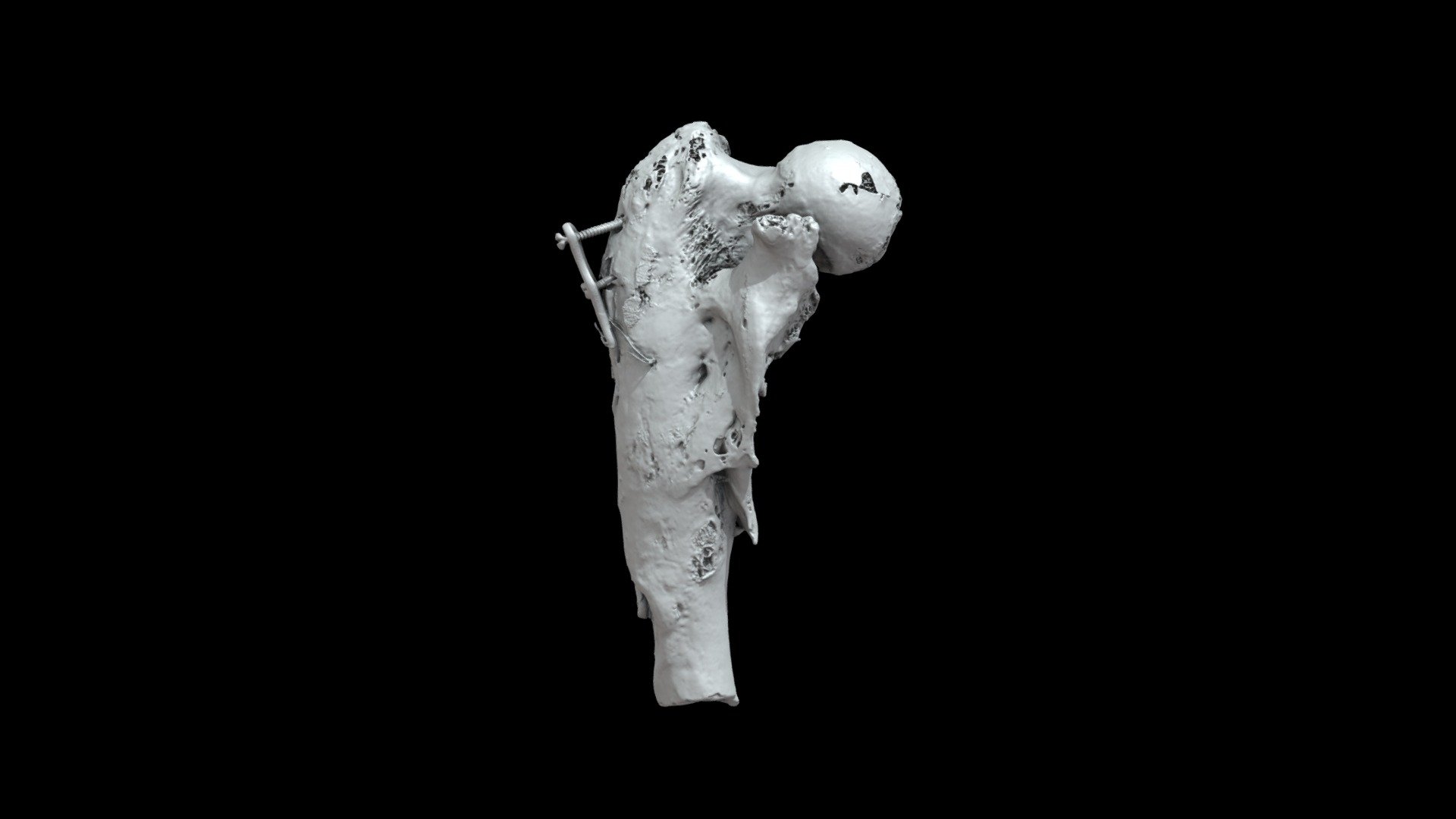 Fractured Femur (VCU_3D_6773) - 3D model by Virtual Curation Lab ...