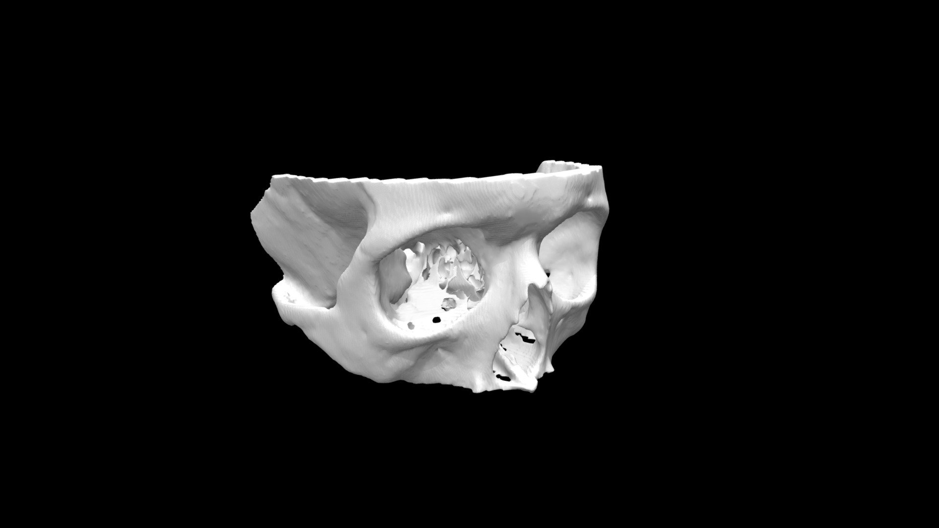 Midface skull - 3D model by Media Studio 3D Print Lab - Addenbrookes ...