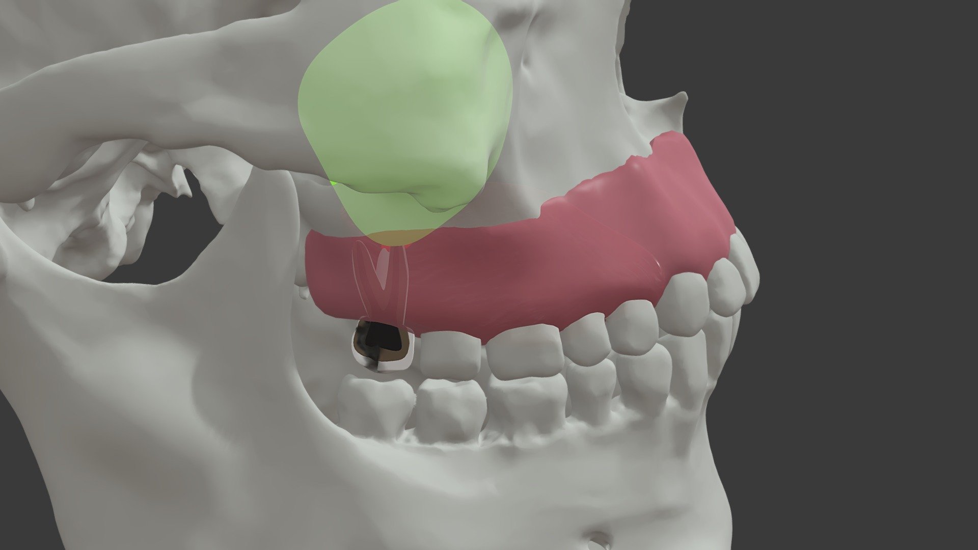 Stage 4 Long Root- Maxillary Sinusitis - 3D model by University of ...