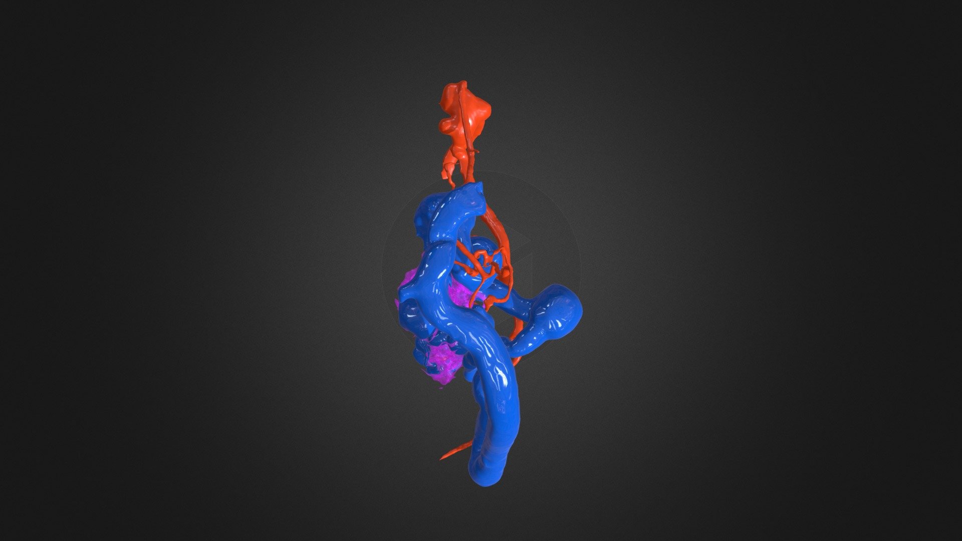 Ruptured AVM - 3D model by jorgegonzalezcantero [0125e7c] - Sketchfab