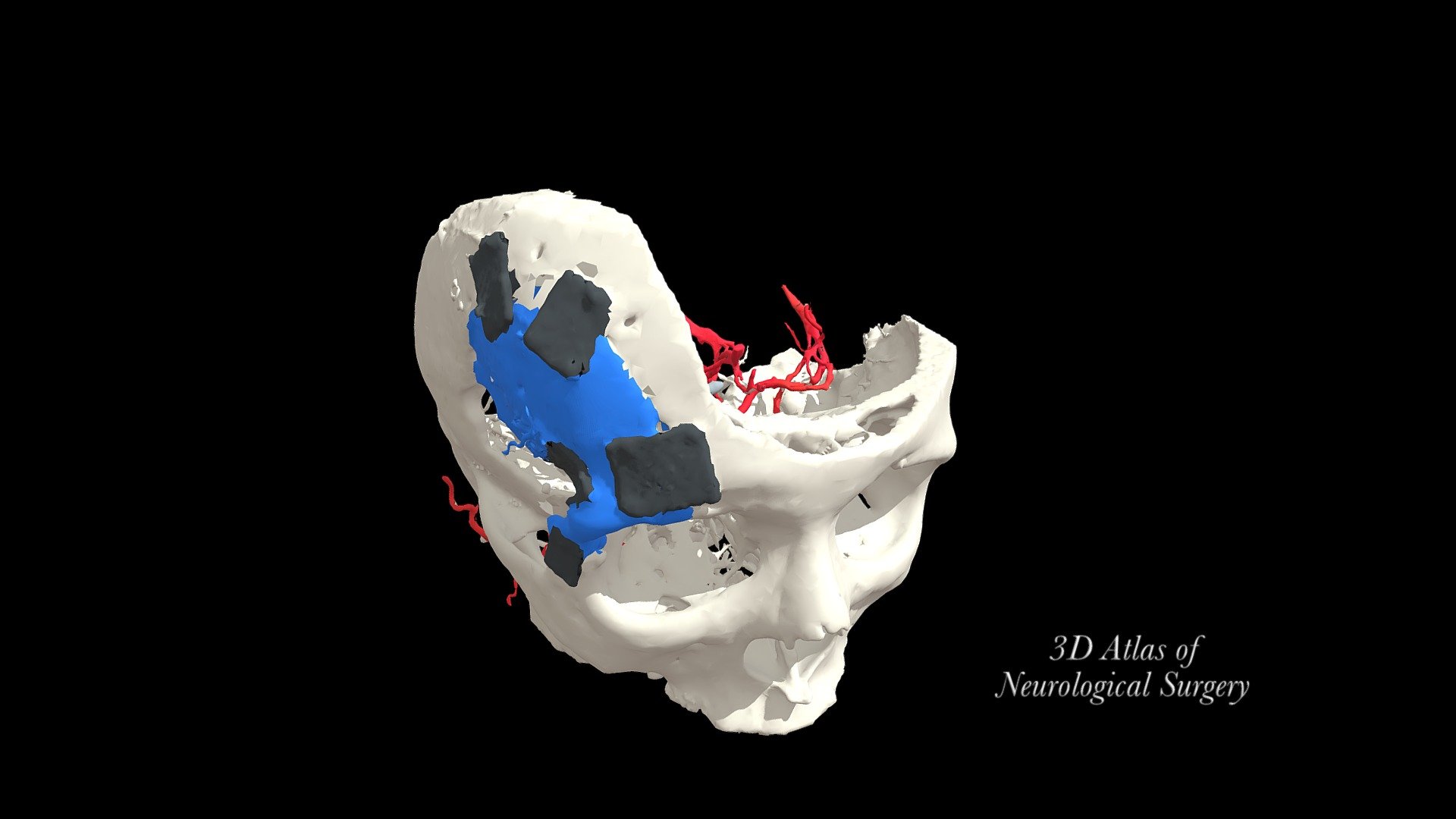 Fronto-orbital craniotomy - 3D model by 3D Atlas of Neurological ...