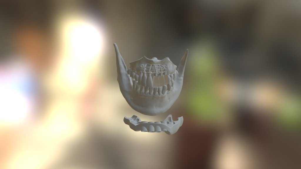 Maxilla Bite Restoration Treatment Proposal - 3D model by drali ...