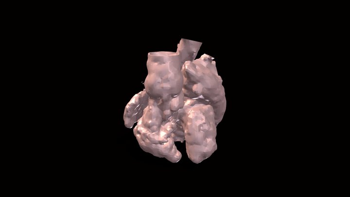 Congenital_heart_disease 3D models - Sketchfab