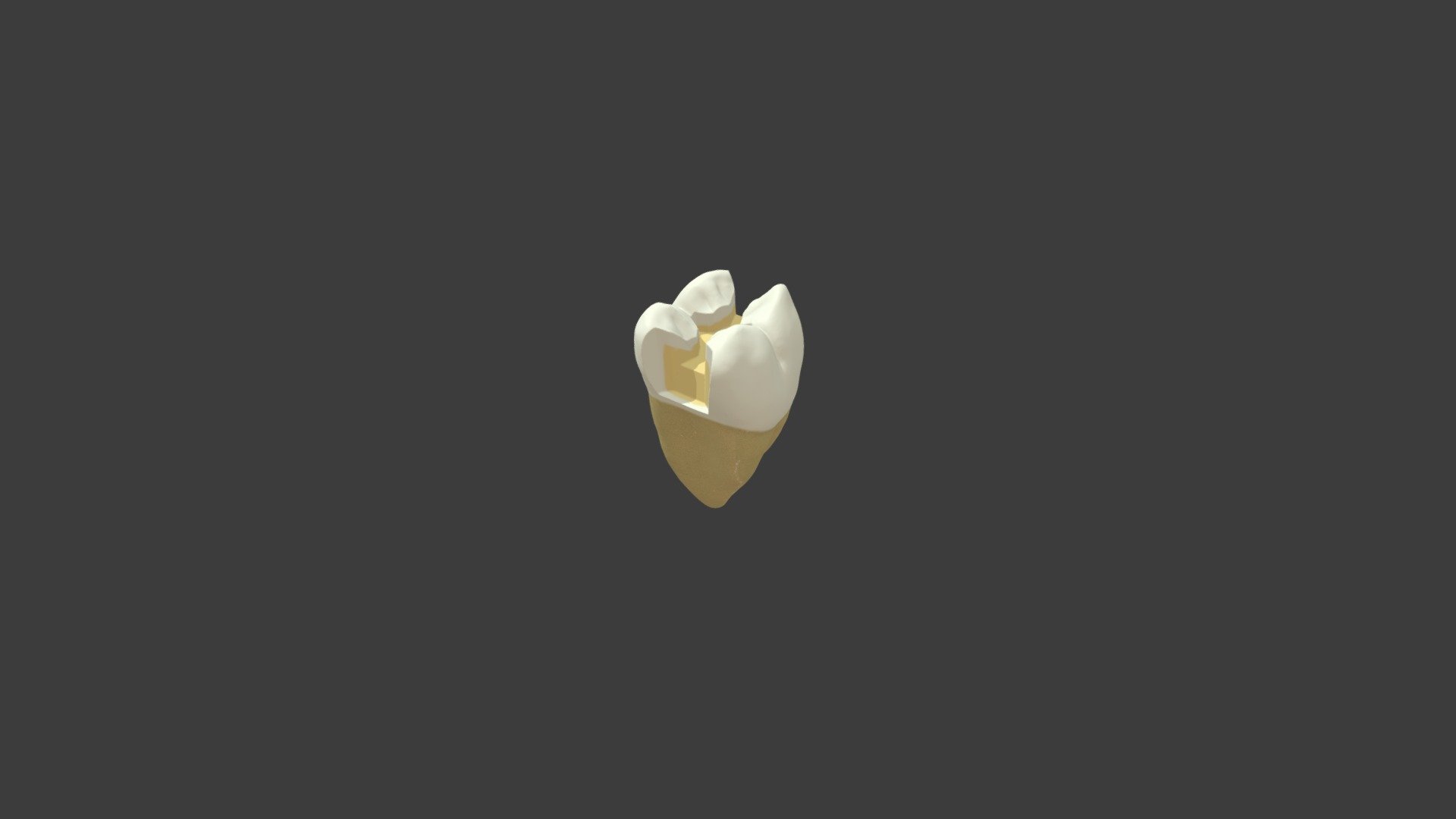 Gold Inlay - preparation - 3D model by Ahmed Mahrous (@drahedmahrous ...