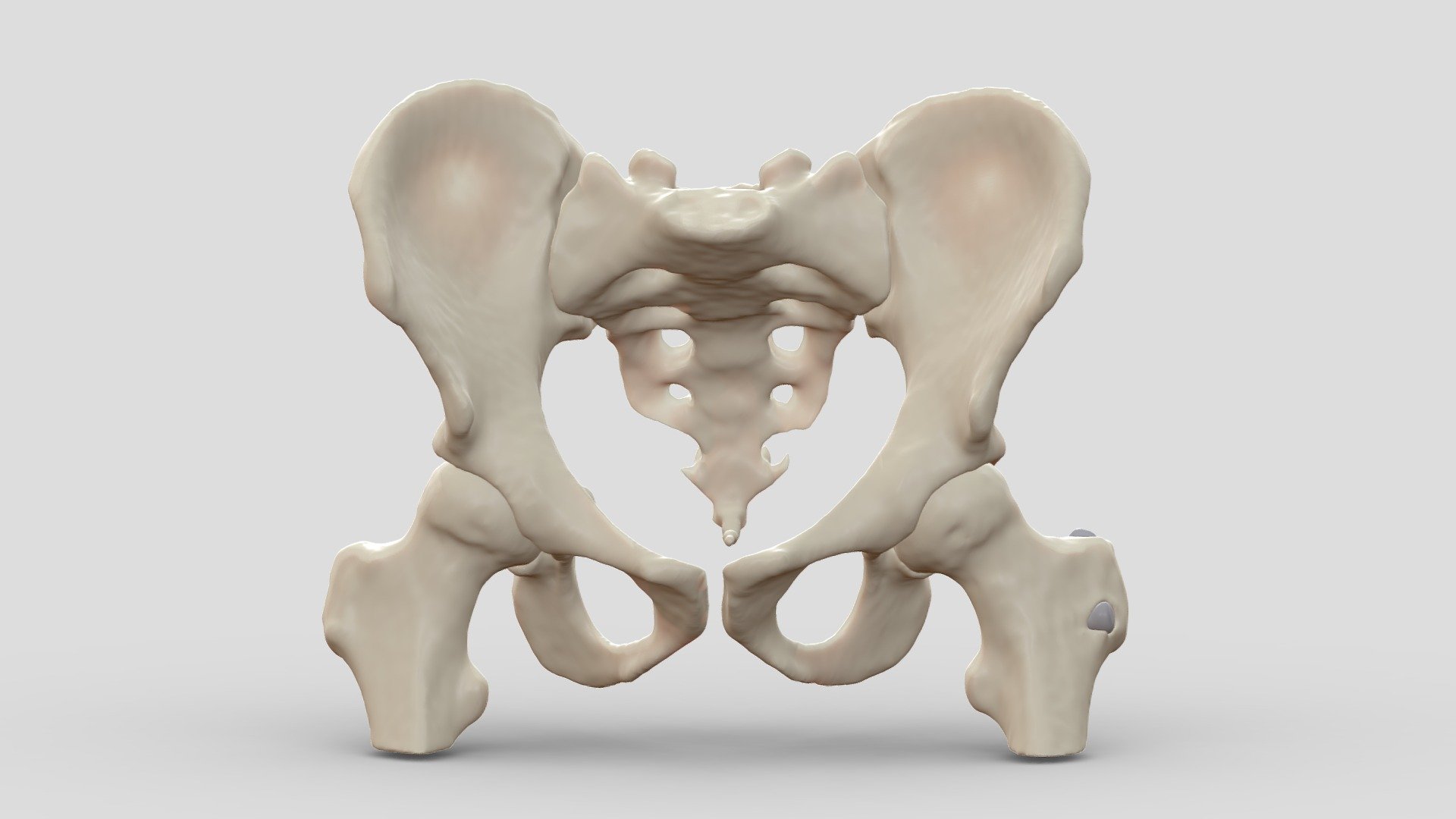 Pelvis with Implant - 3D model by Terrie Simmons-Ehrhardt ...