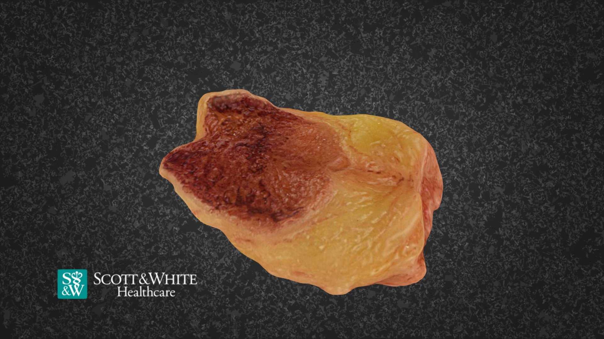 Strawberry Gallbladder 156601 - 3D model by Scott & White Moulage ...