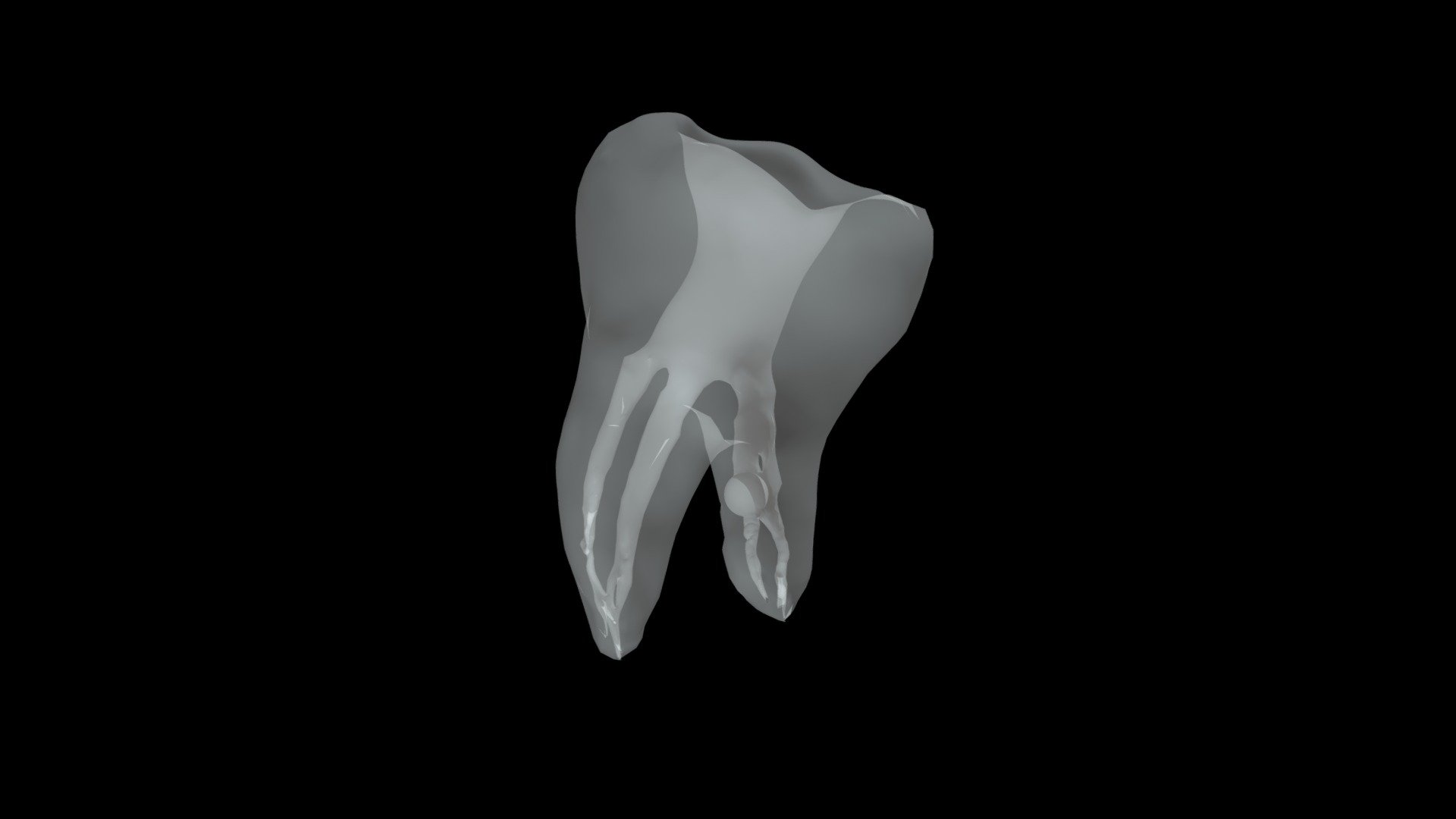 #30 With Internal Resorption - 3D model by biomed3d [03ed7cd] - Sketchfab