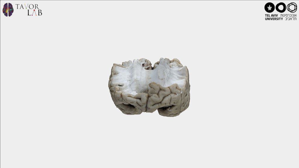 Brain - Cadaver - A 3D model collection by alex1136 - Sketchfab