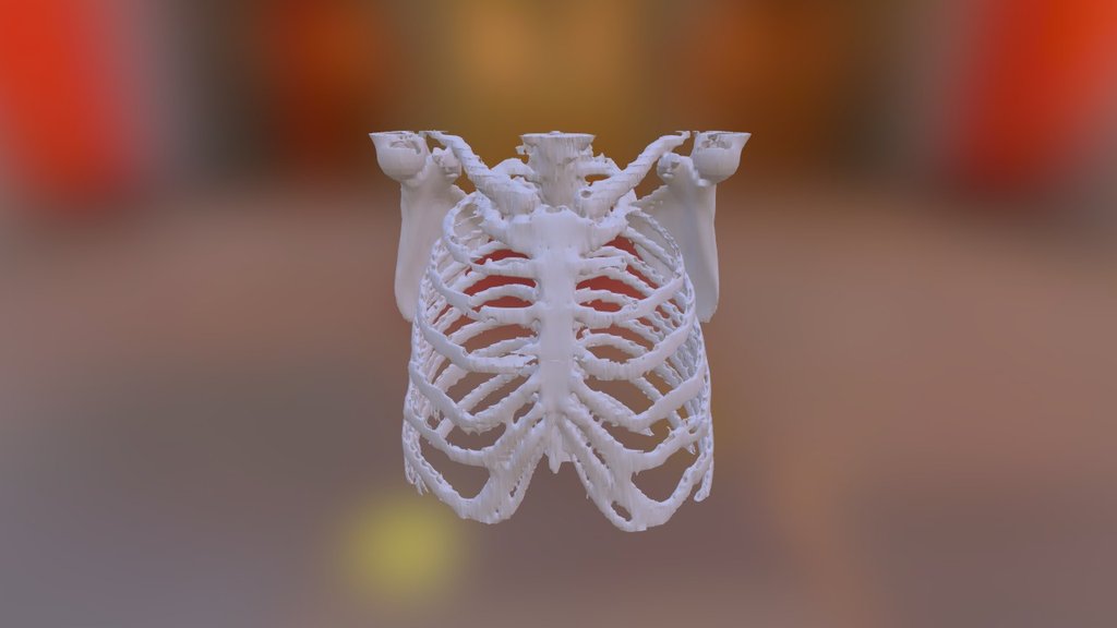 Rib Fracture-2 - 3D model by FablabNDMC [0592e12] - Sketchfab