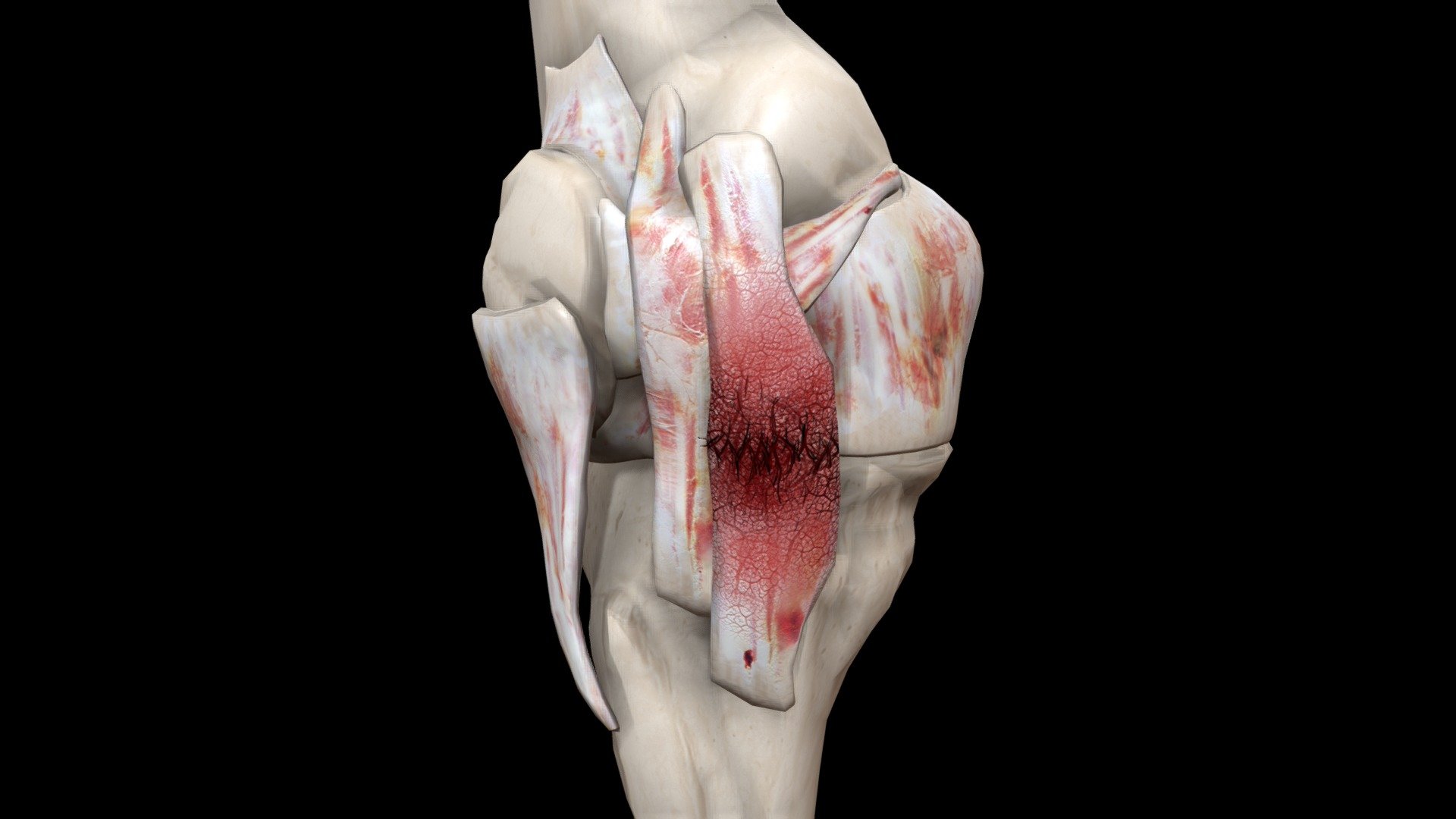 MCL tear - 3D model by Connections XR (@connectionsxr) [064a3aa ...
