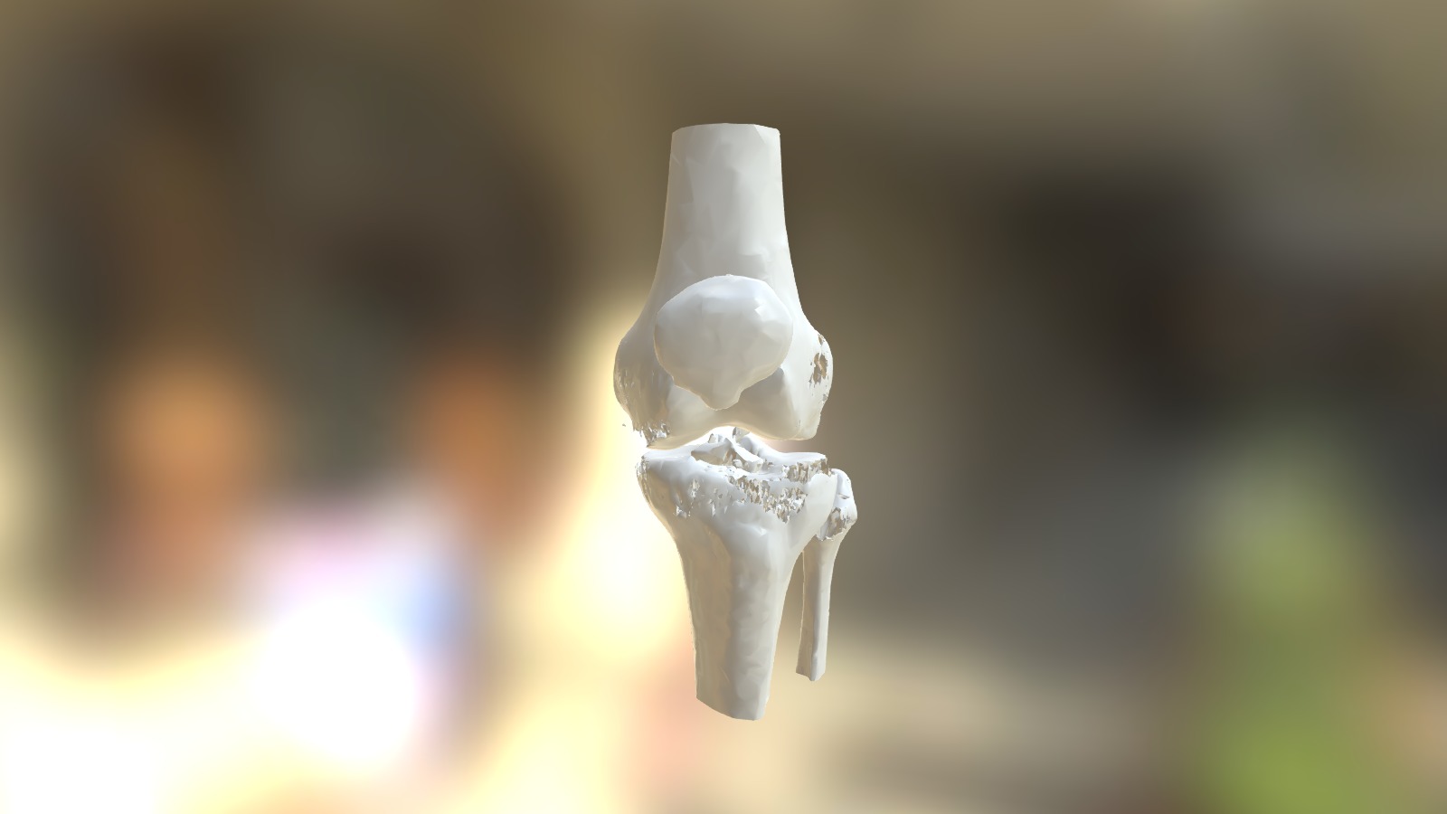 Knee - Proximal Tibia Fracture sku 048 - 3D model by orto3d [06d695b ...
