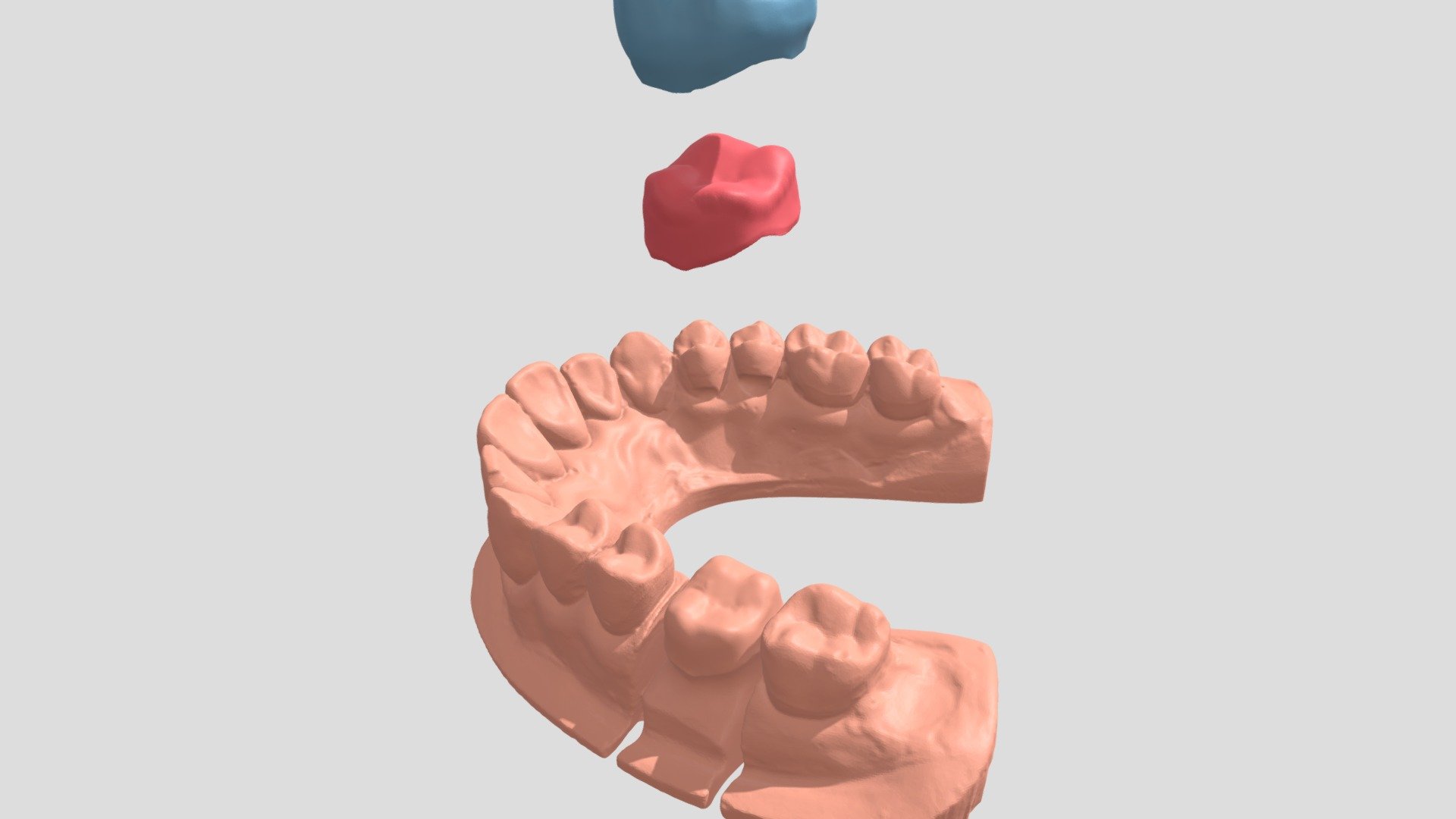 ExtraCoronal Crown - 3D model by Eric Ho (@justericho) [0767947 ...