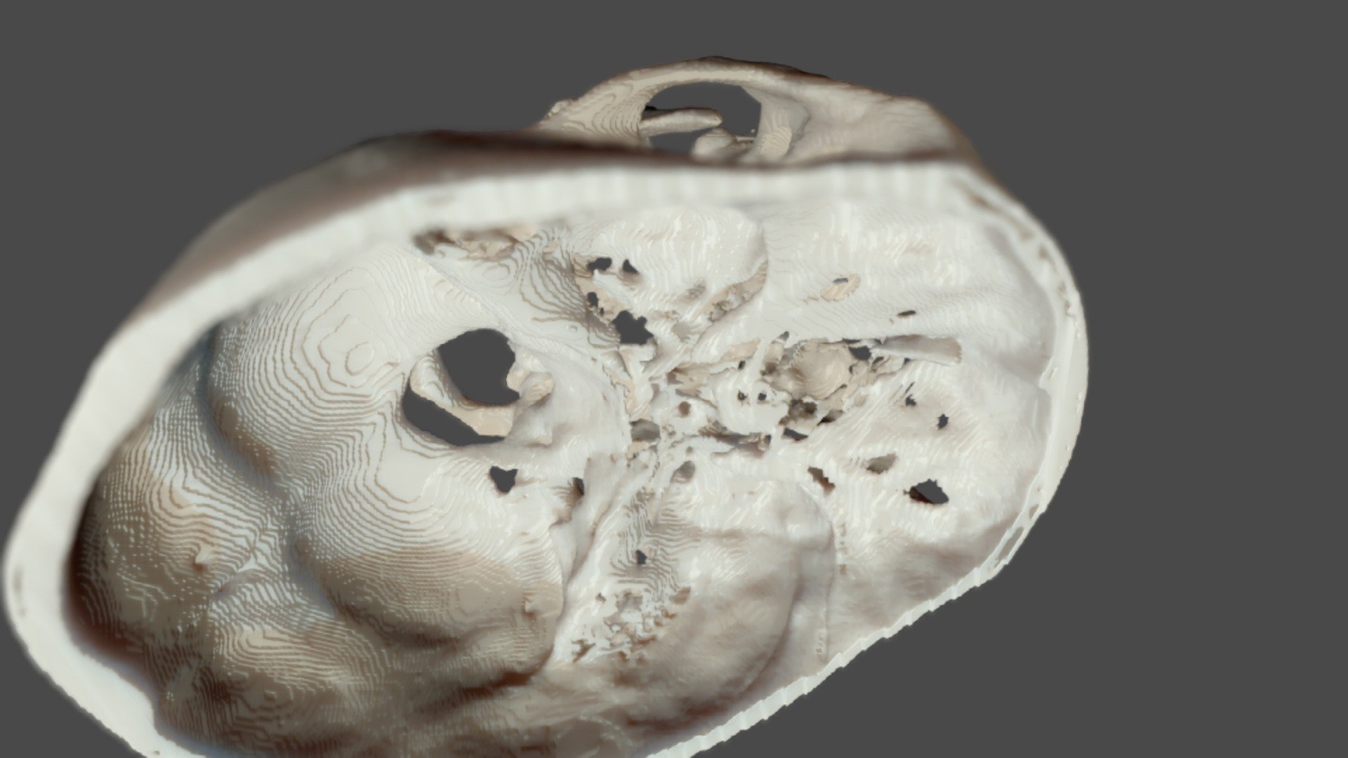 Skull base CT - Download Free 3D model by Nicolás González R, MD ...