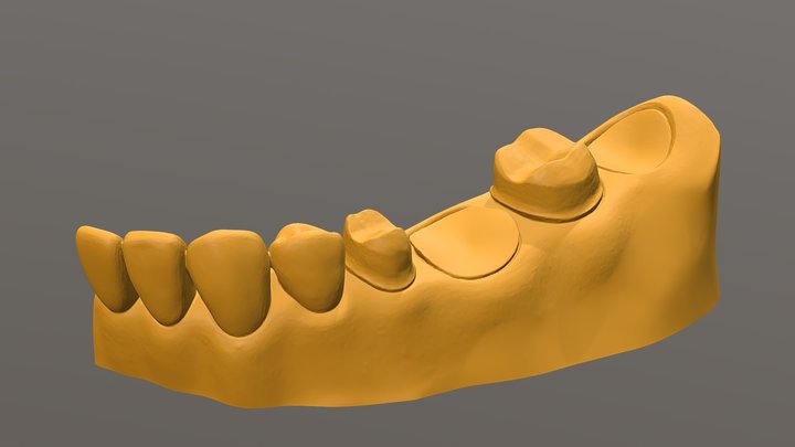 Prosthodontics 3D models - Sketchfab