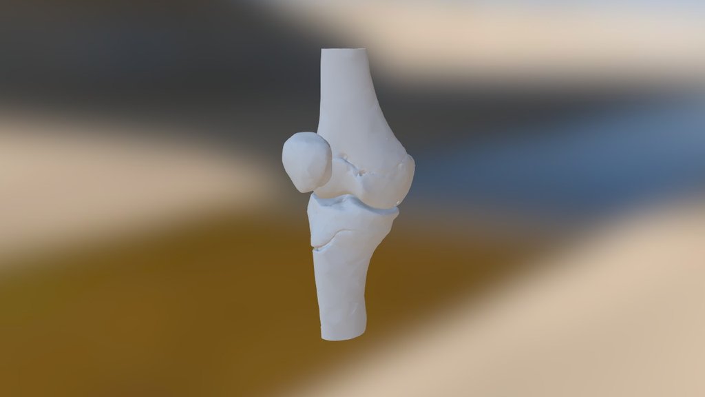 Knee - Proximal Tibia Fracture sku 040 - 3D model by orto3d [0872283 ...