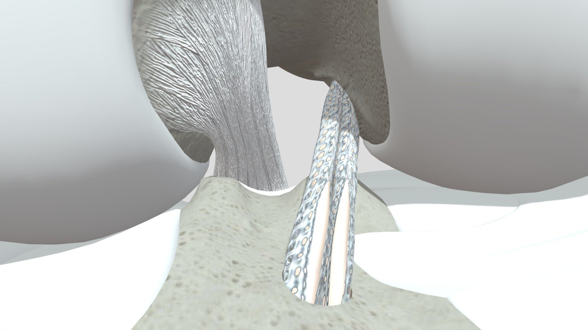 JewelACL™ Partial Tissue Graft Sparing technique - 3D model by Xiros ...