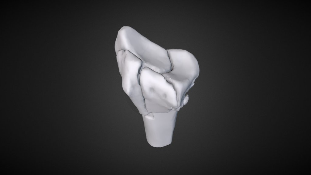 DKOU17 | #5 Distal Radius (L-162022-R) - 3D model by World Surgery Tour ...