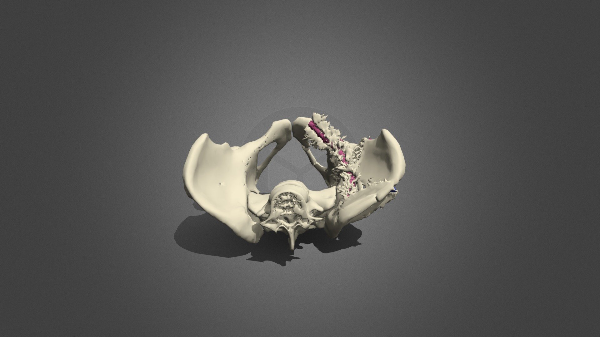 Fractured Pelvis with Hardware - Download Free 3D model by andrewohull ...