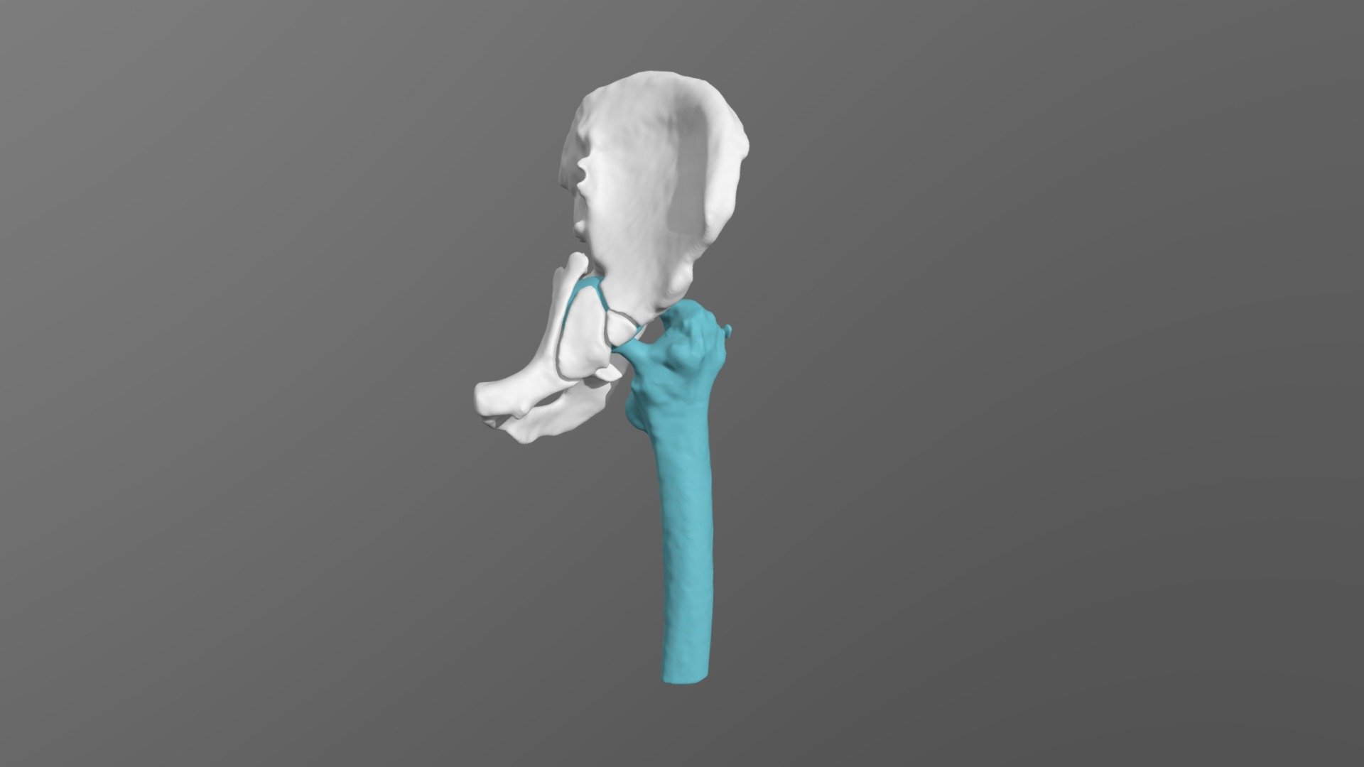 Acetabular fracture - 3D model by valchanov [091fc98] - Sketchfab