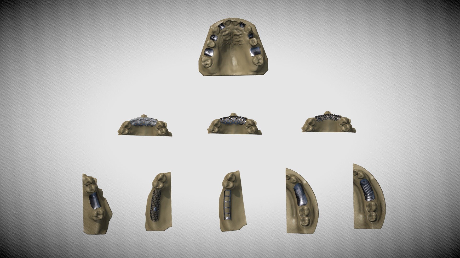 Denture Base Retention Minor Connector - 3D model by Muhammad Nabeel ...