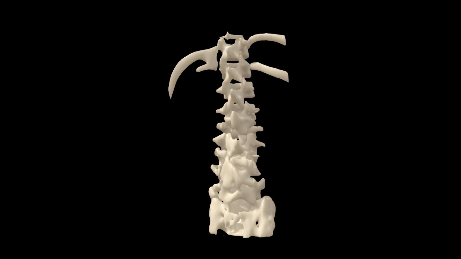 Lumbar Segmentation Anomalies 2 - 3D model by Lincoln Wong ...