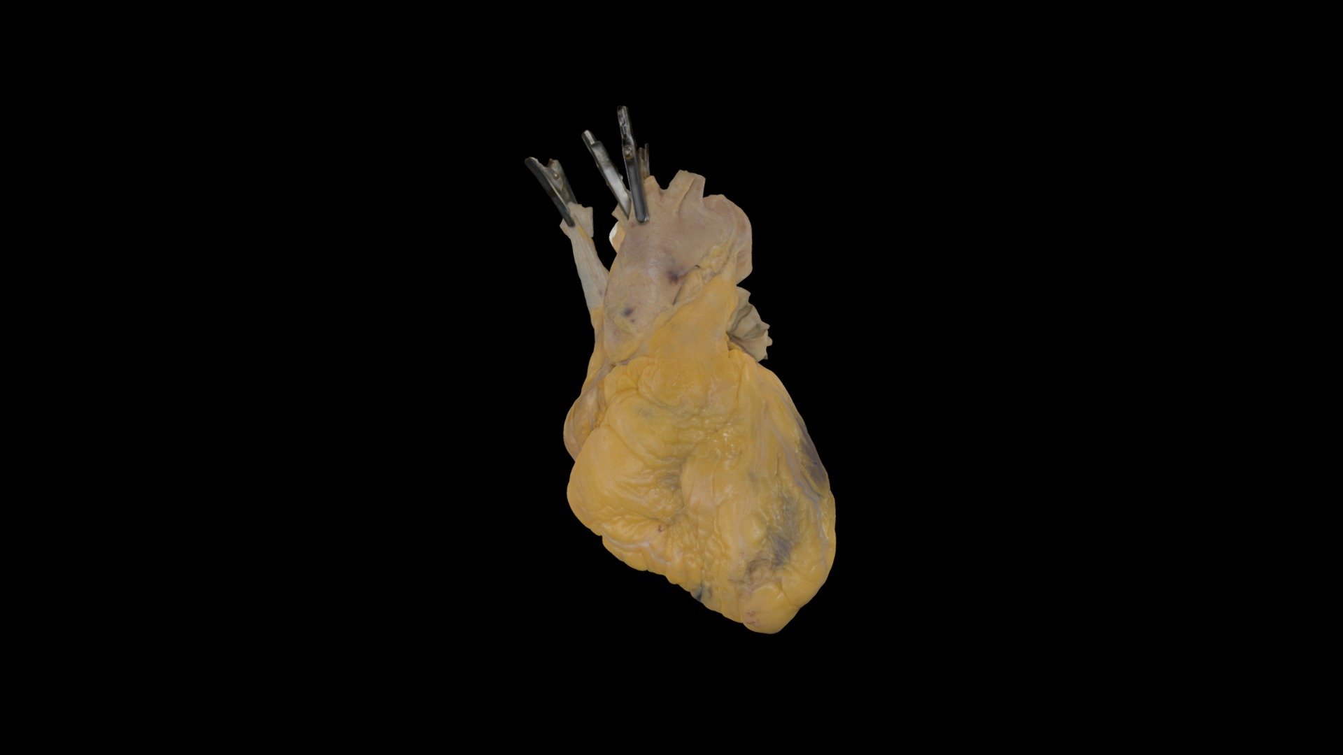 Fixed Human Heart Donation - Download Free 3D model by VisibleHeartLabs ...