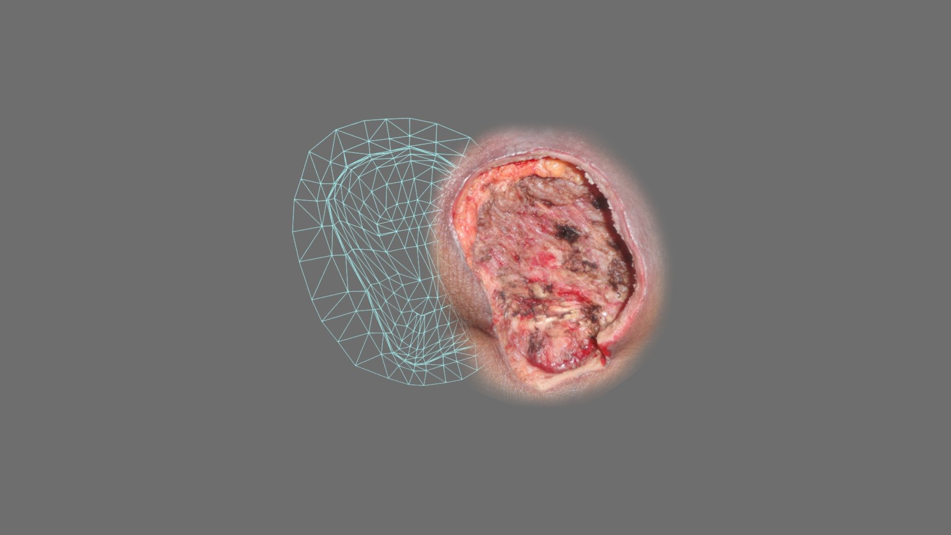 Wound - 3D model by Girish.Kinge [0a4d775] - Sketchfab
