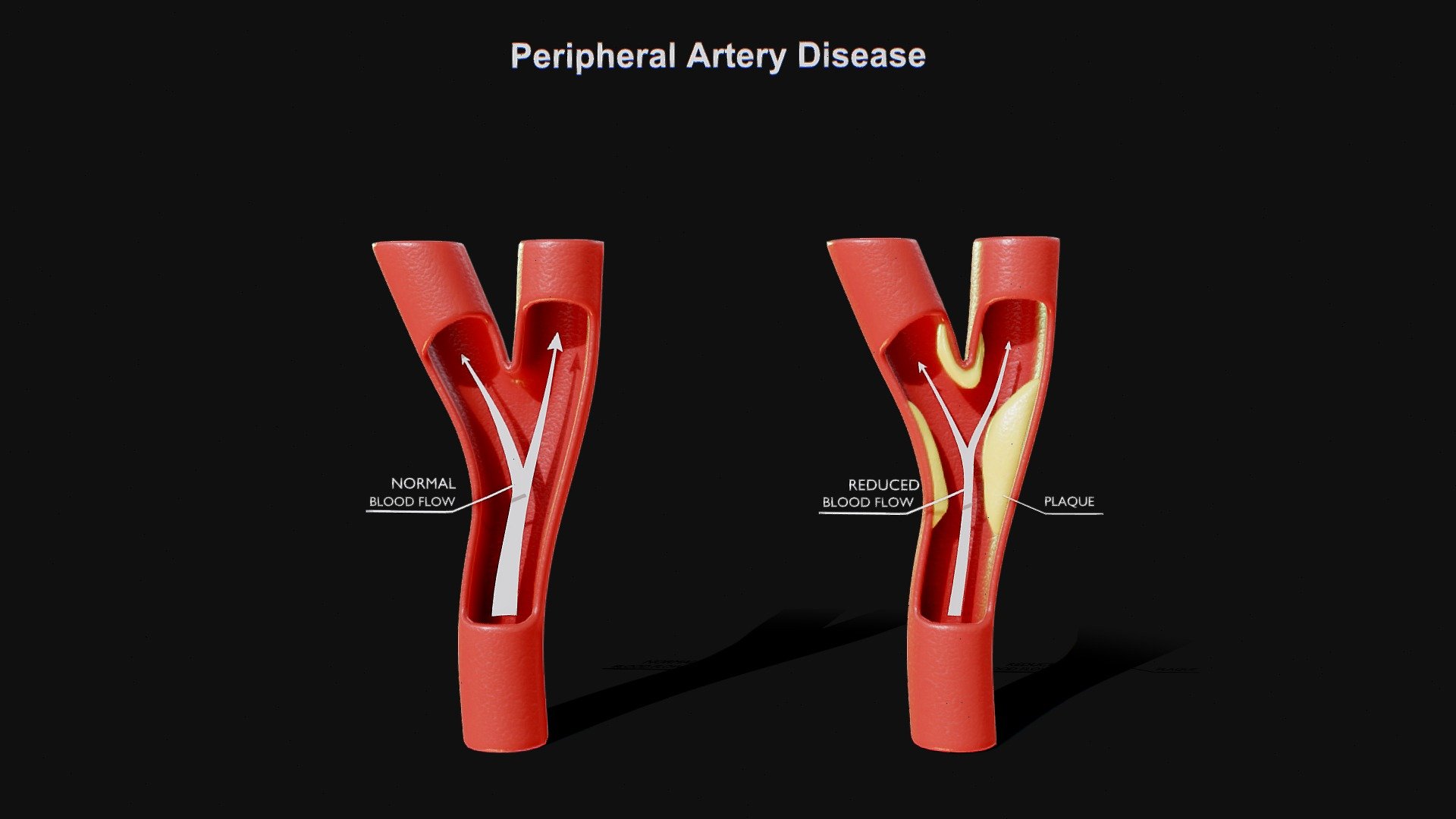 Peripheral Artery Disease - Buy Royalty Free 3D model by Nima ...