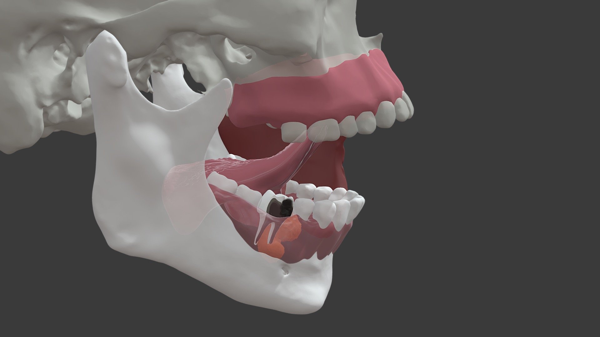 Stage 4- Mandibular Molar Infection Pathway 3 - 3D model by University ...