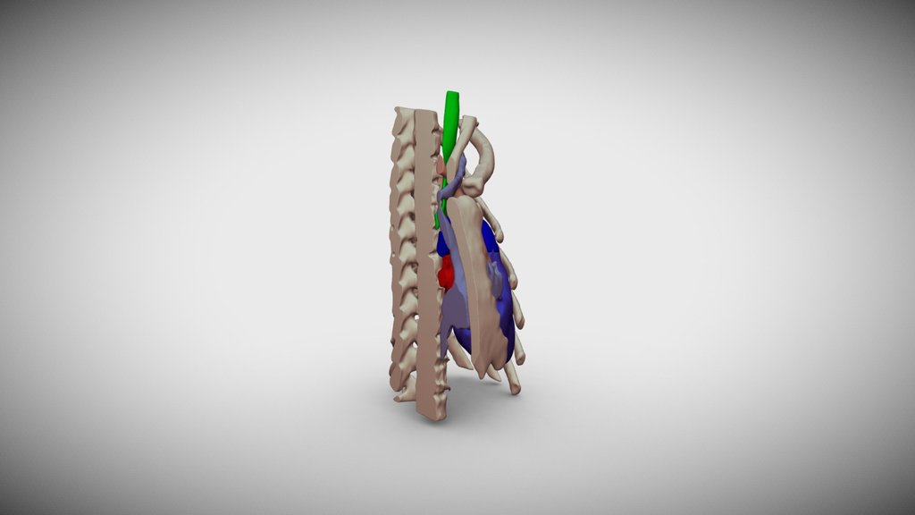 Straight back syndrome - A 3D model collection by Imre J. Barabás, MD ...