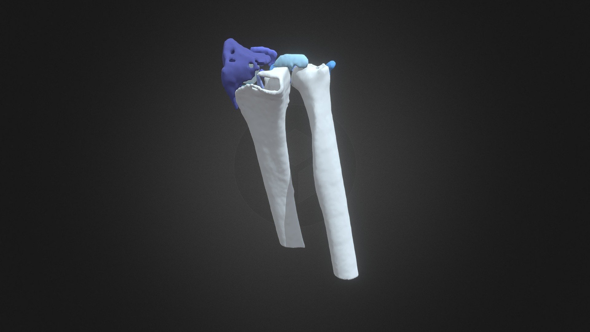 Distal Radius Fx for AOFB Meeting | Sep 2021 - 3D model by World ...