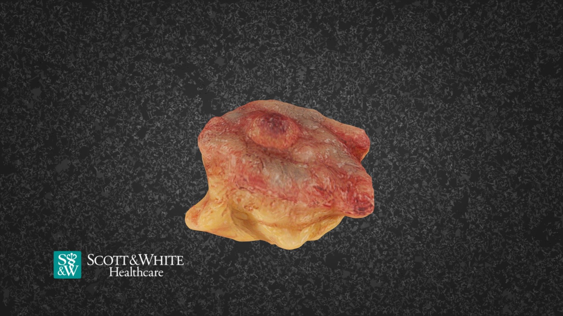Bladder - Squamous Cell Epithelioma 128875 - 3D model by Scott & White ...