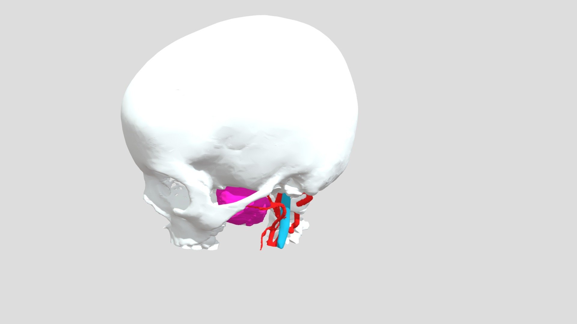Osteosarcoma CT Angiogram (S0261) - 3D model by NCH Advanced Projects ...