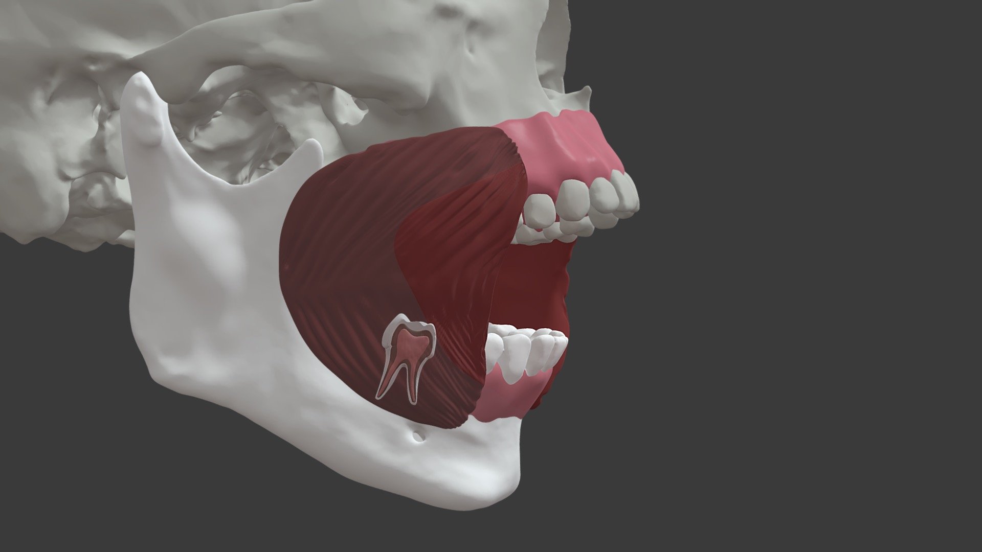 Stage 1- Mandibular Molar Infection Pathway 1 - 3D model by University ...