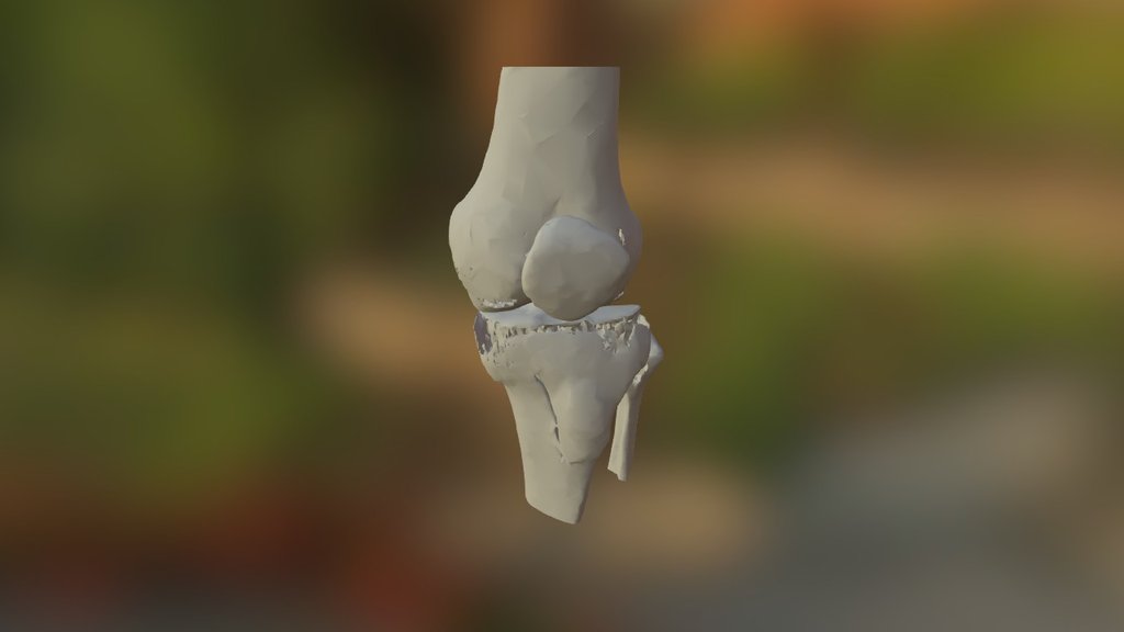 Knee - Proximal Tibia Fracture sku 046 - 3D model by orto3d [0c87889 ...