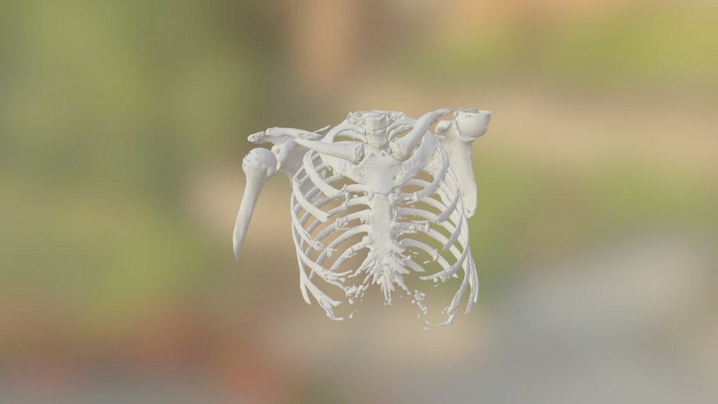 Rib Fracture-1 - 3D model by FablabNDMC [0d8a6fd] - Sketchfab