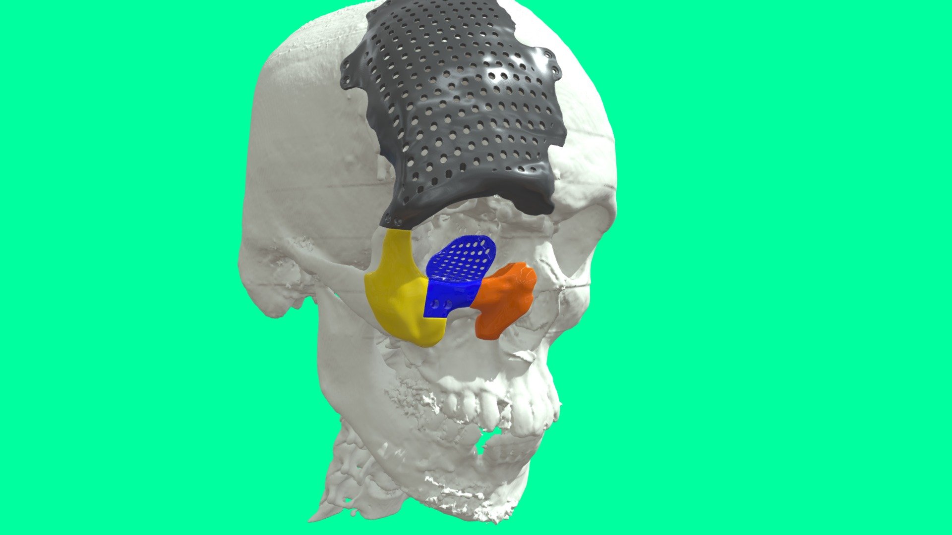 Case ID: 31098029; Patient Name: Christapher - 3D model by LUCID ...