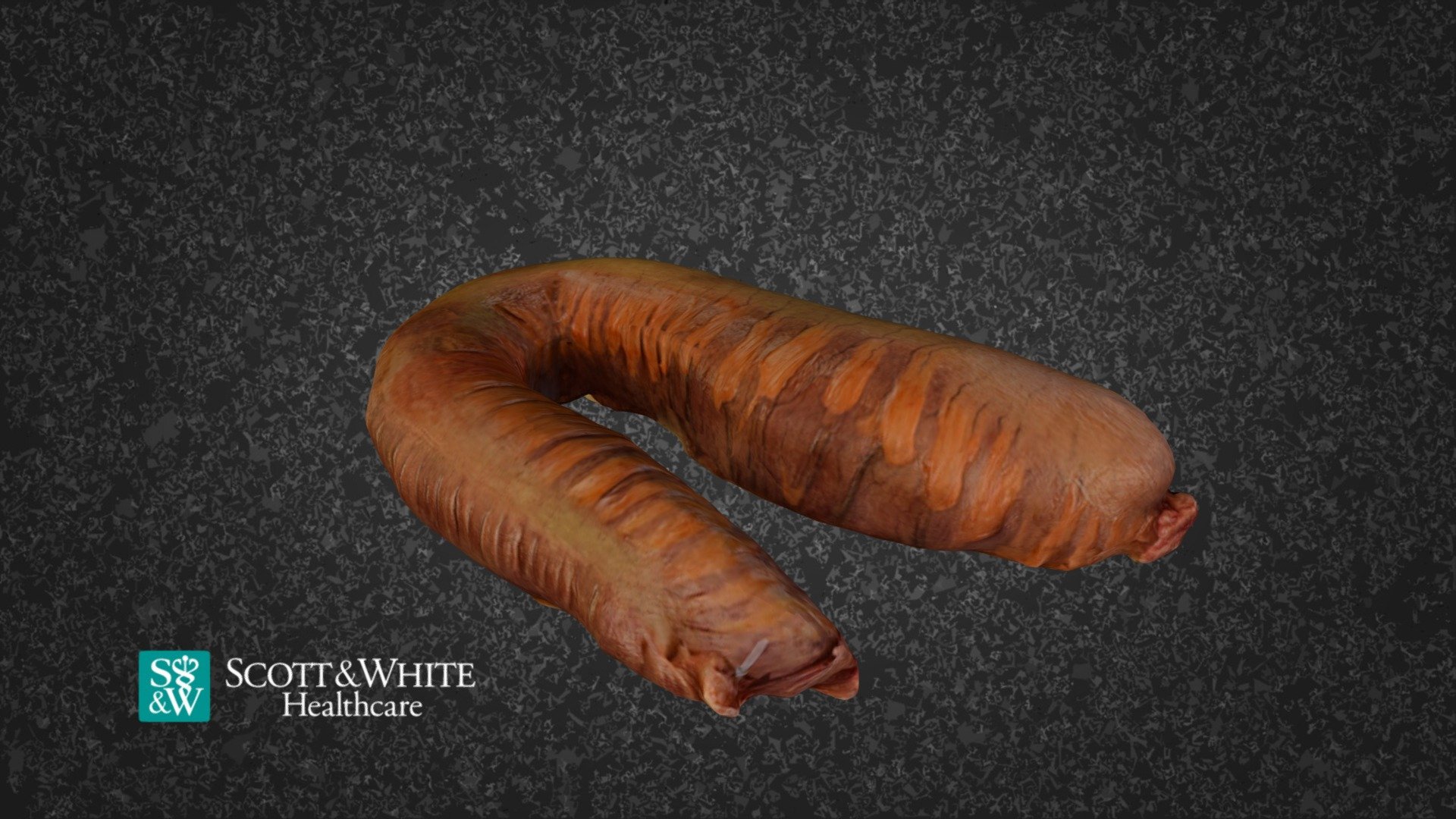 Sigmoid Colon- Distended and Infected 278126 - 3D model by Scott ...