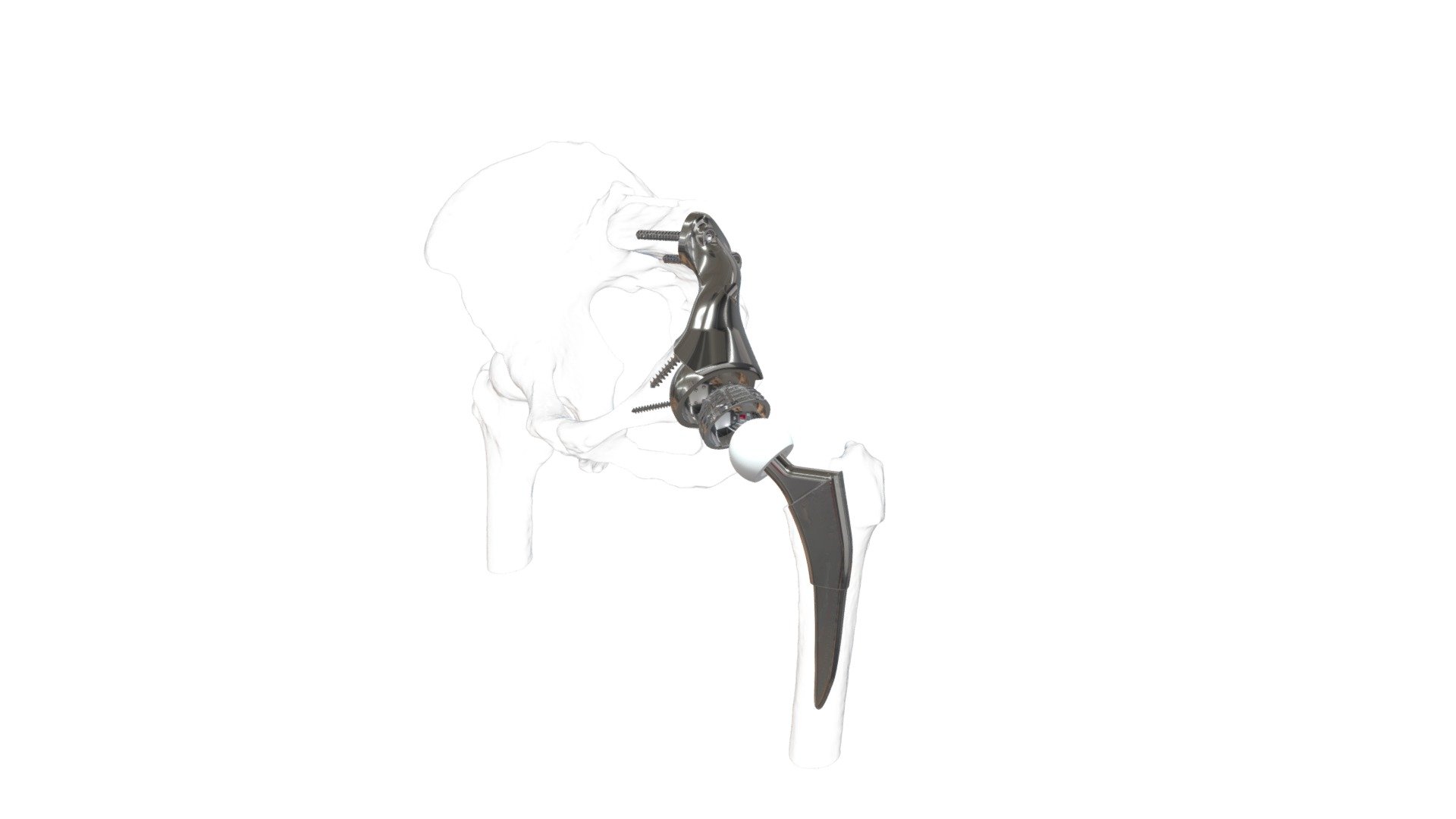 Pelvic endo-prosthesis - 3D model by SkeletoMy [0f0dadd] - Sketchfab