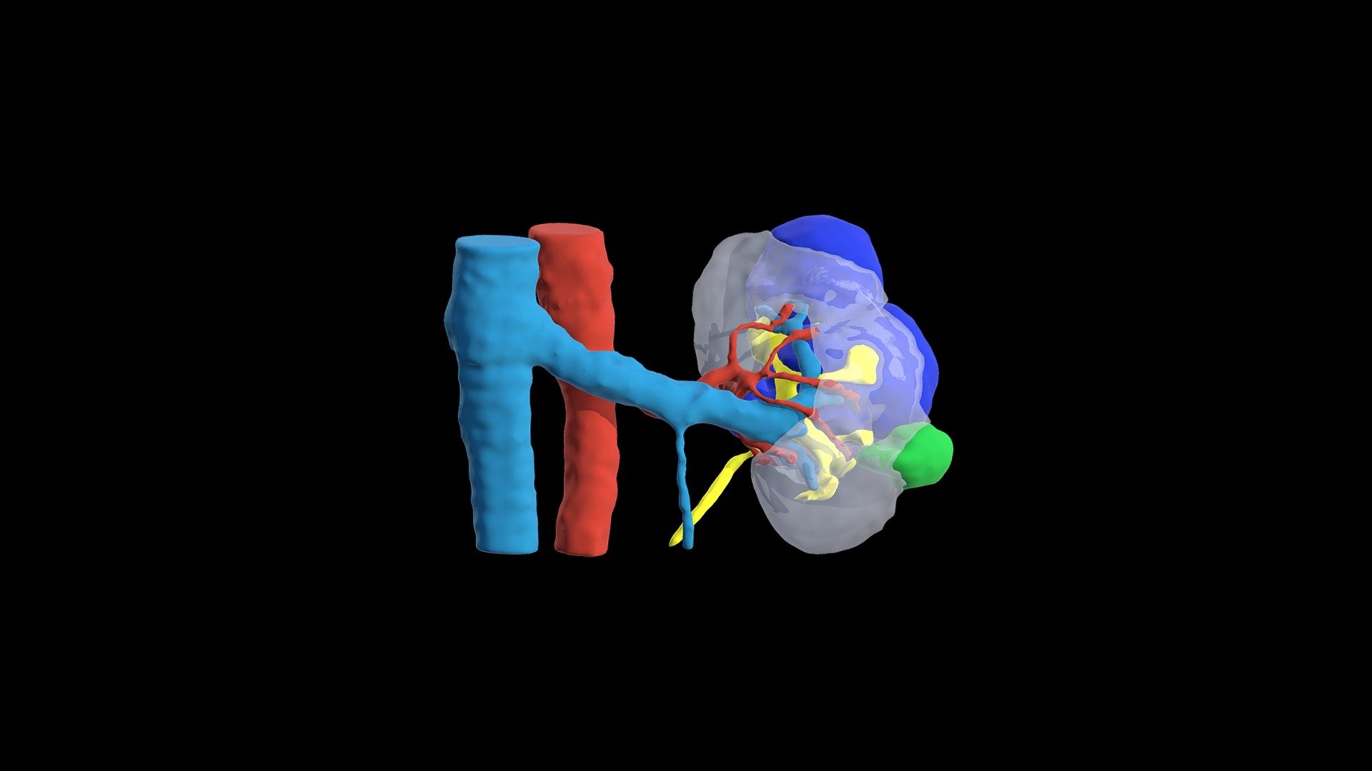 Left Renal Tumor - 3D model by Cirurgic3D (@neorenal) [0f68eb2] - Sketchfab