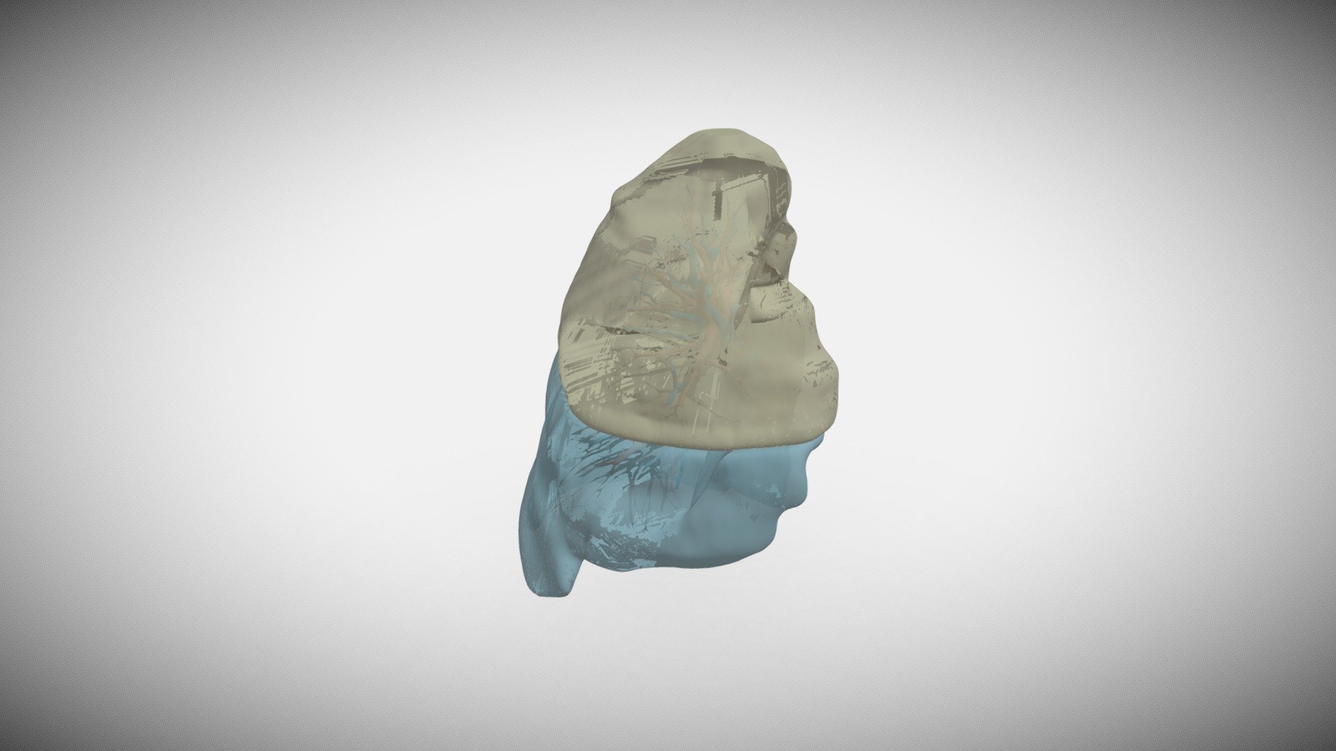 Lung tumor - 3D model by Imre J. Barabás, MD, M.Sc. (@Uzzias18 ...
