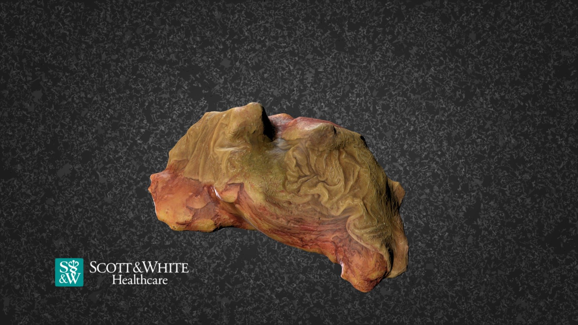 Descending Colon Annular Scirrhous 193093 - 3D model by Scott & White ...