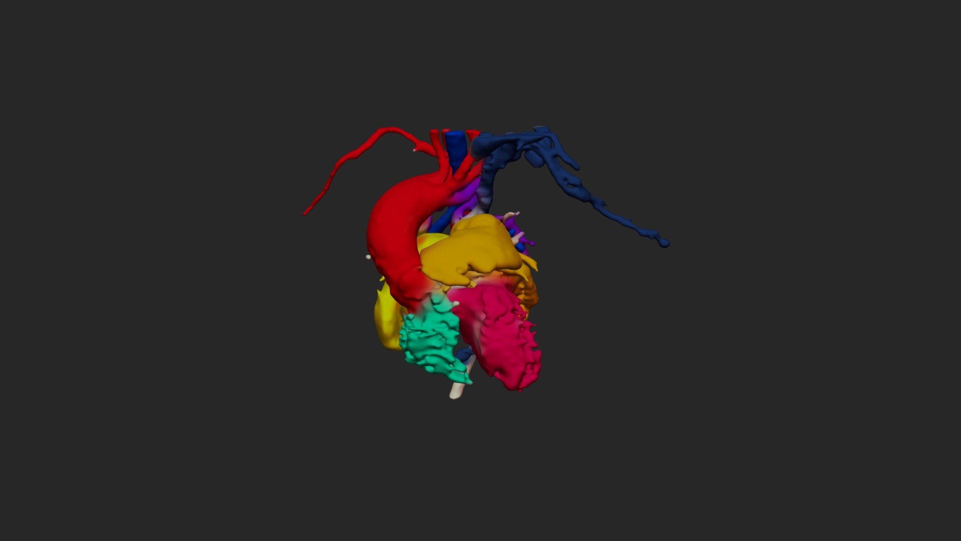 Heterotaxy - TOF with pulmonary atresia - Download Free 3D model by ...