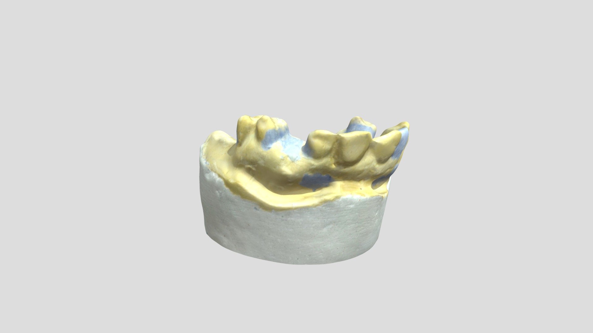 Partial Denture Upper Cast Scan - Download Free 3D model by Omar Eiada ...