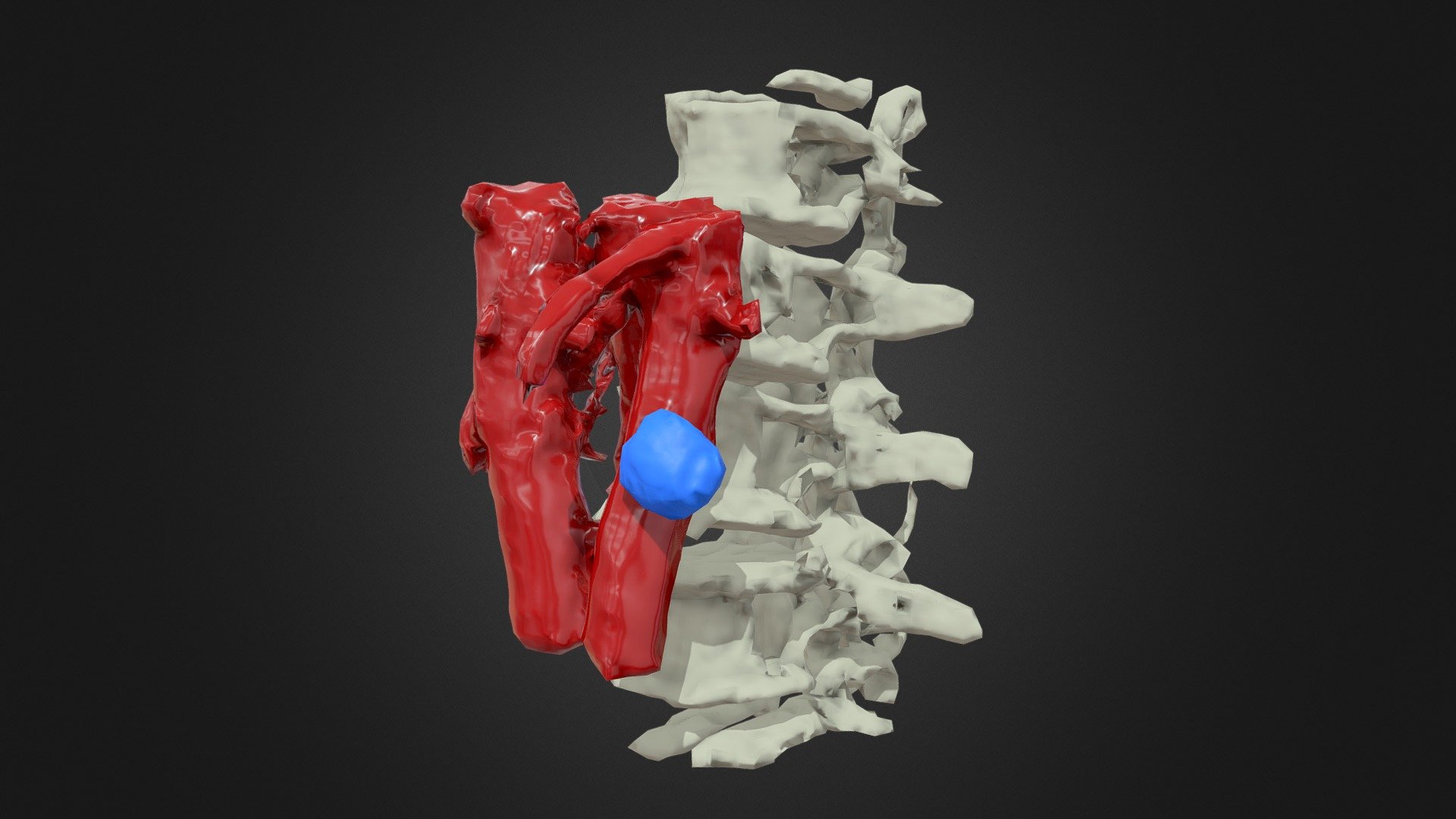 Tumor - 3D model by Edmund 3D (@edmund3d) [1113b61] - Sketchfab
