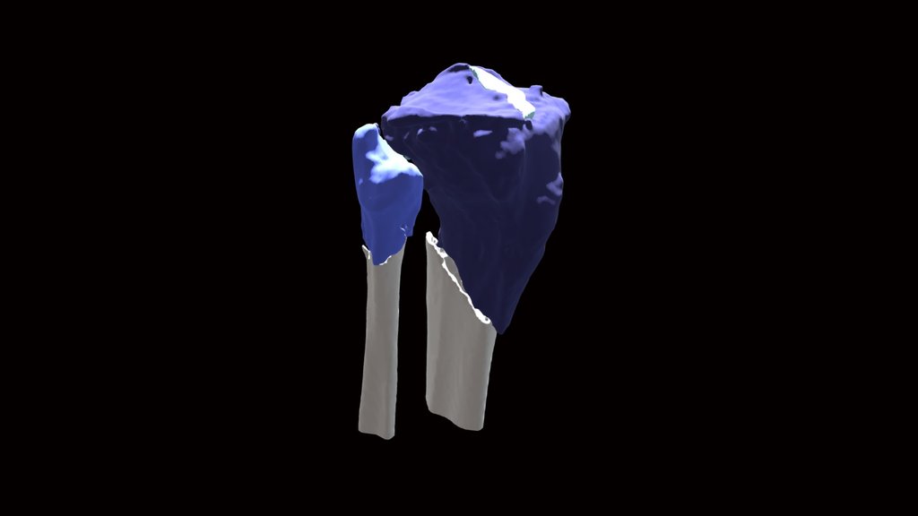 WST Festival 2023 - Proximal Tibia Fractures - A 3D model collection by ...