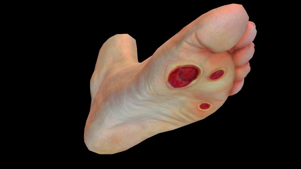 Diabetic Foot (With Ulcers) - 3D model by Gaia Tech (@gaiatech ...