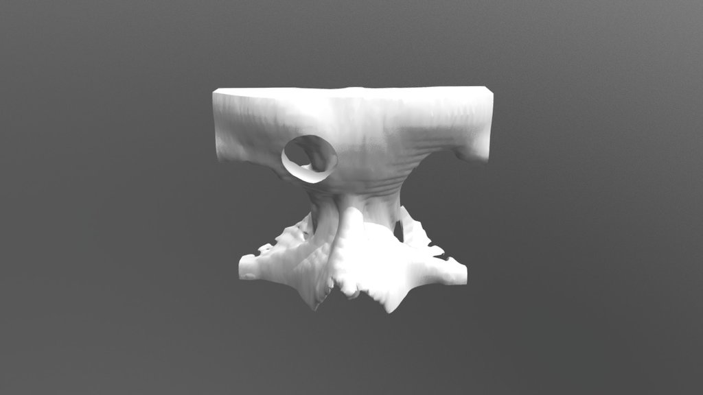 Recurrent frontal sinusitis - Osteotomy - 3D model by skyf16 [12a633f ...