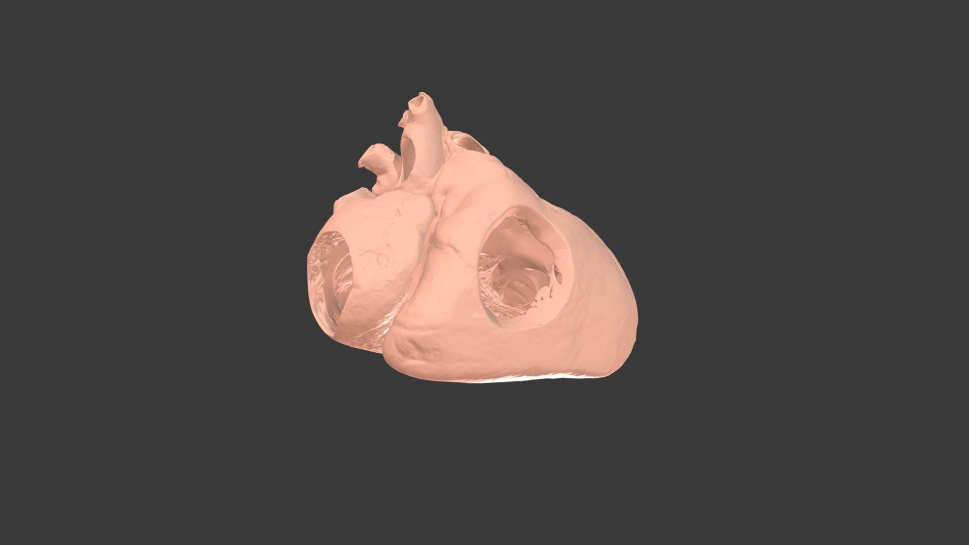 ASD #1 - T21, {S,D,S} with ASD 1, ASD 2 - 3D model by heartmodels ...