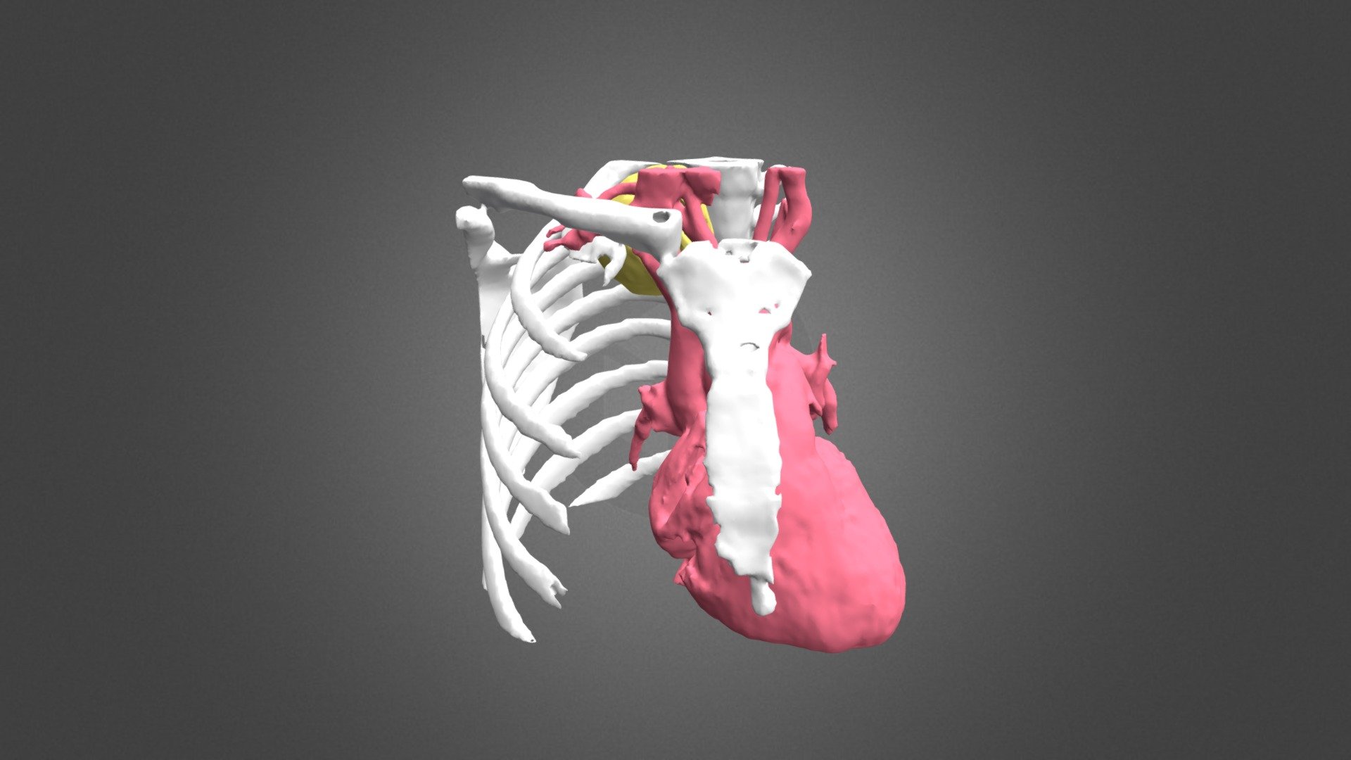 Tumor - 3D model by ryumedik [1327a84] - Sketchfab